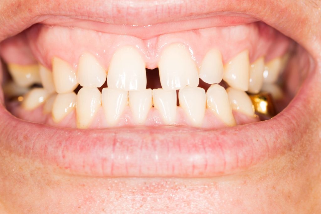 Diastema. Learn about them and how you can fix them.