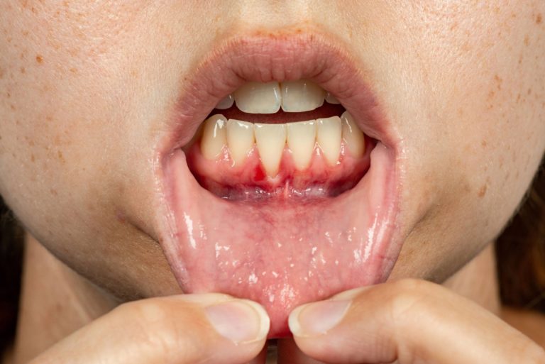 What Is A Frenectomy? - Brampton, ON Dentist - Salvaggio Dentistry